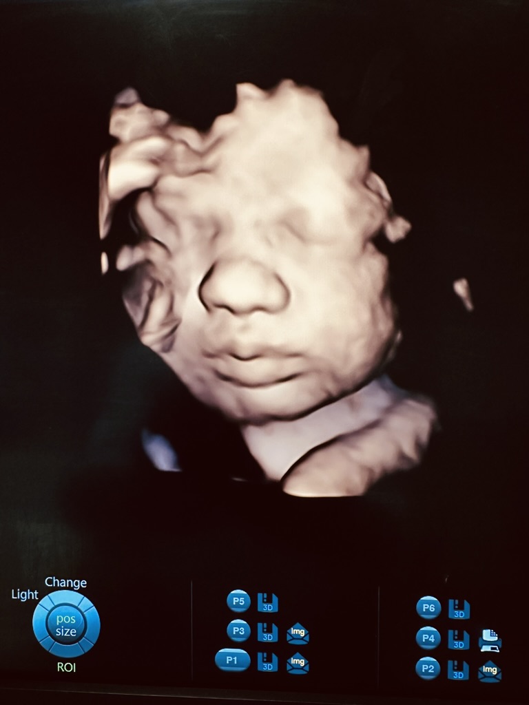 4D Ultrasound Scan | Private Baby Ultrasound Scans | MUMS