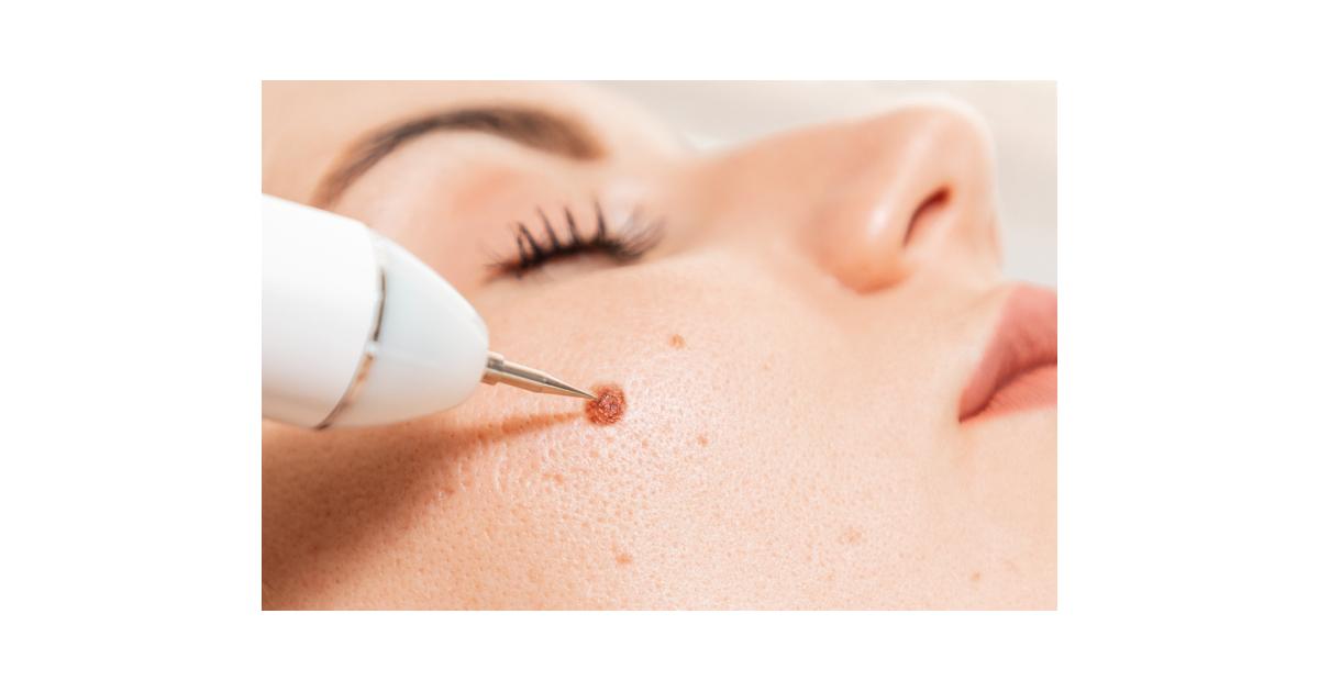 Private Mole Assessment and Mole Removal | MUMS Solihull