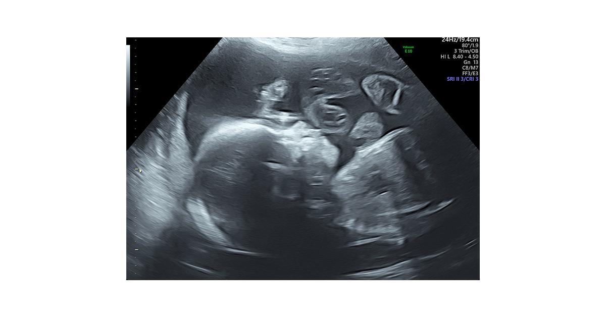 Anomaly Ultrasound Scan | 20 Week Scan Solihull Ultrasound